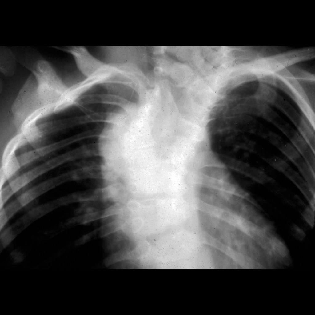 Pediatric Vertebral Body Anomalies | Pediatric Radiology Reference ...