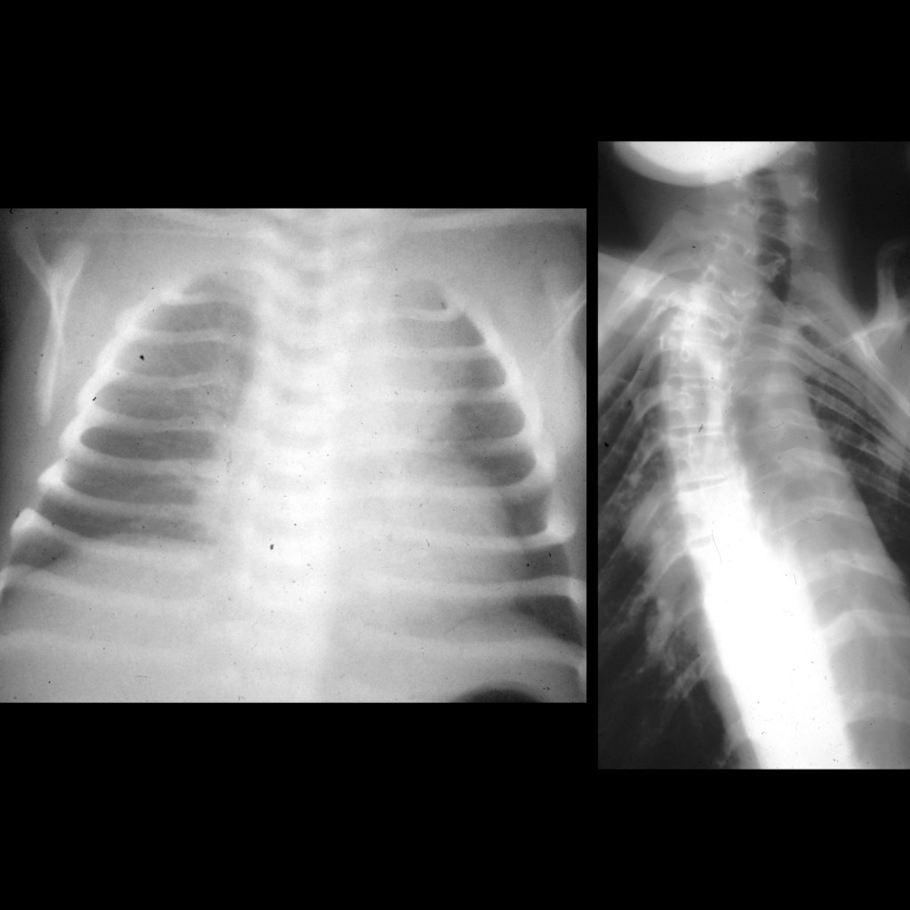 Post Radiation Scoliosis | Pediatric Radiology Reference Article ...