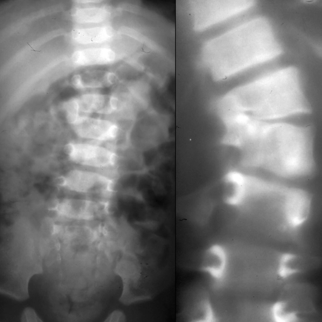 Pediatric Vertebral Body Anomalies | Pediatric Radiology Reference ...