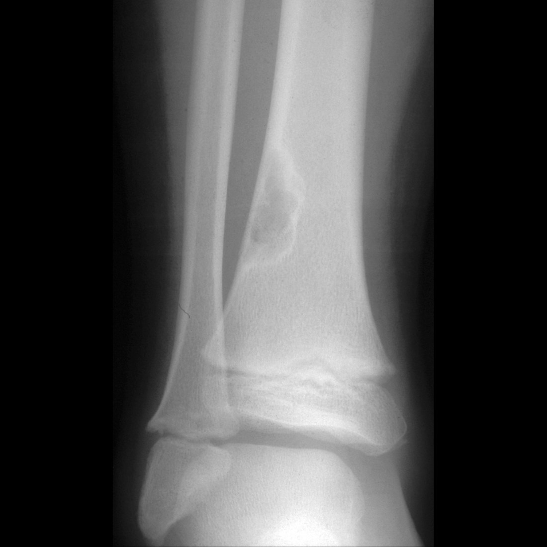 Non Ossifying Fibroma | Pediatric Radiology Reference Article ...