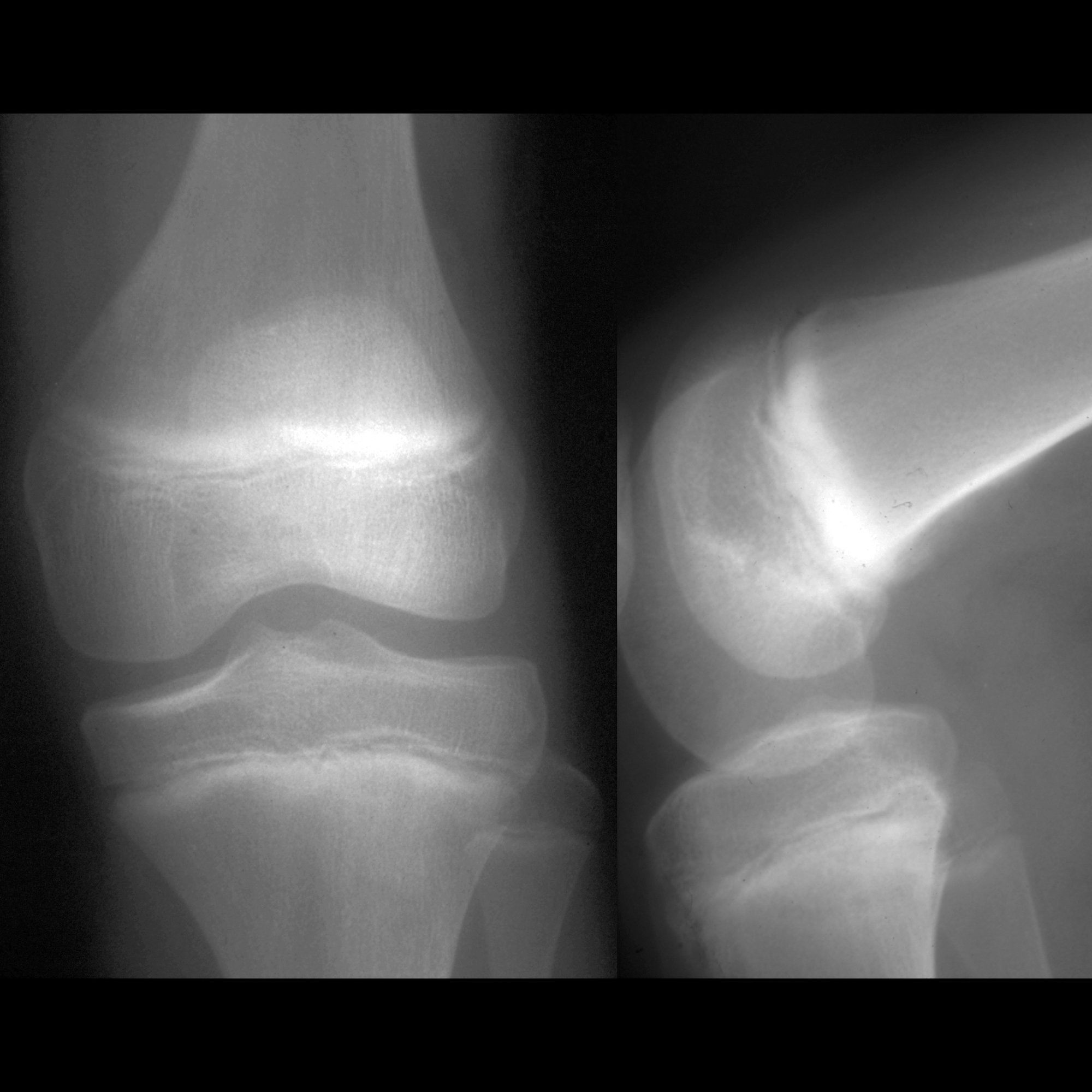 Pediatric Cortical Desmoid | Pediatric Radiology Reference Article ...