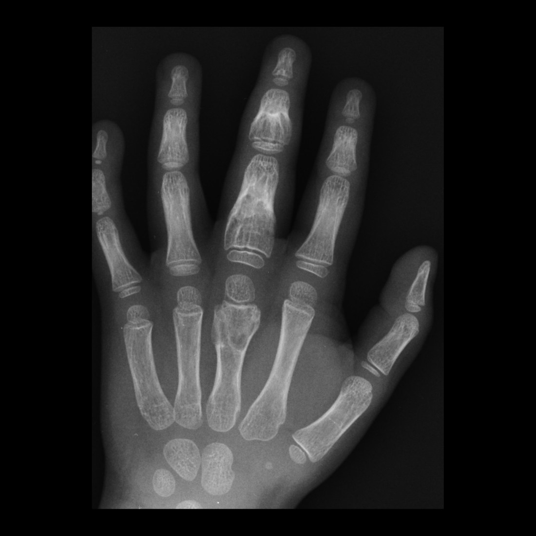 Enchondromatosis – Ollier Disease | Pediatric Radiology Reference ...