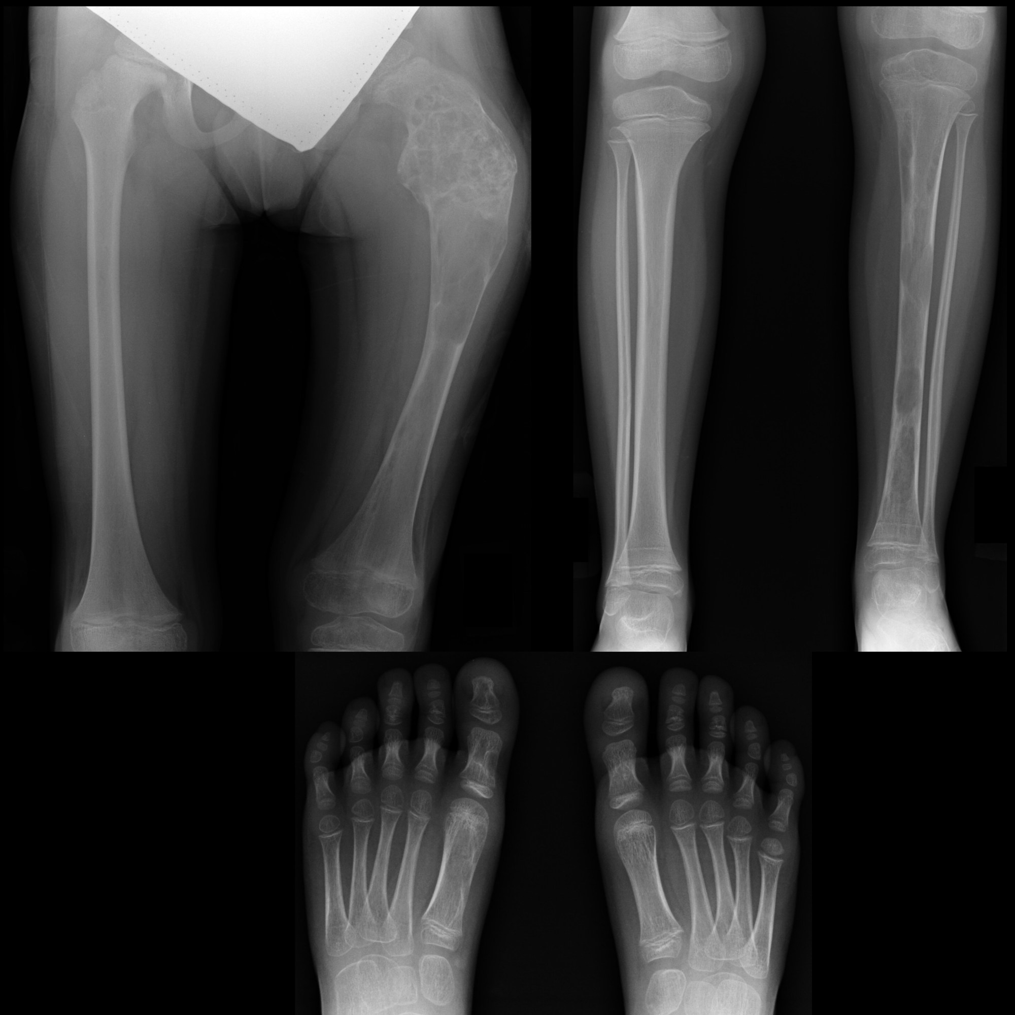 School ager with left leg pain | Pediatric Radiology Case | Pediatric ...