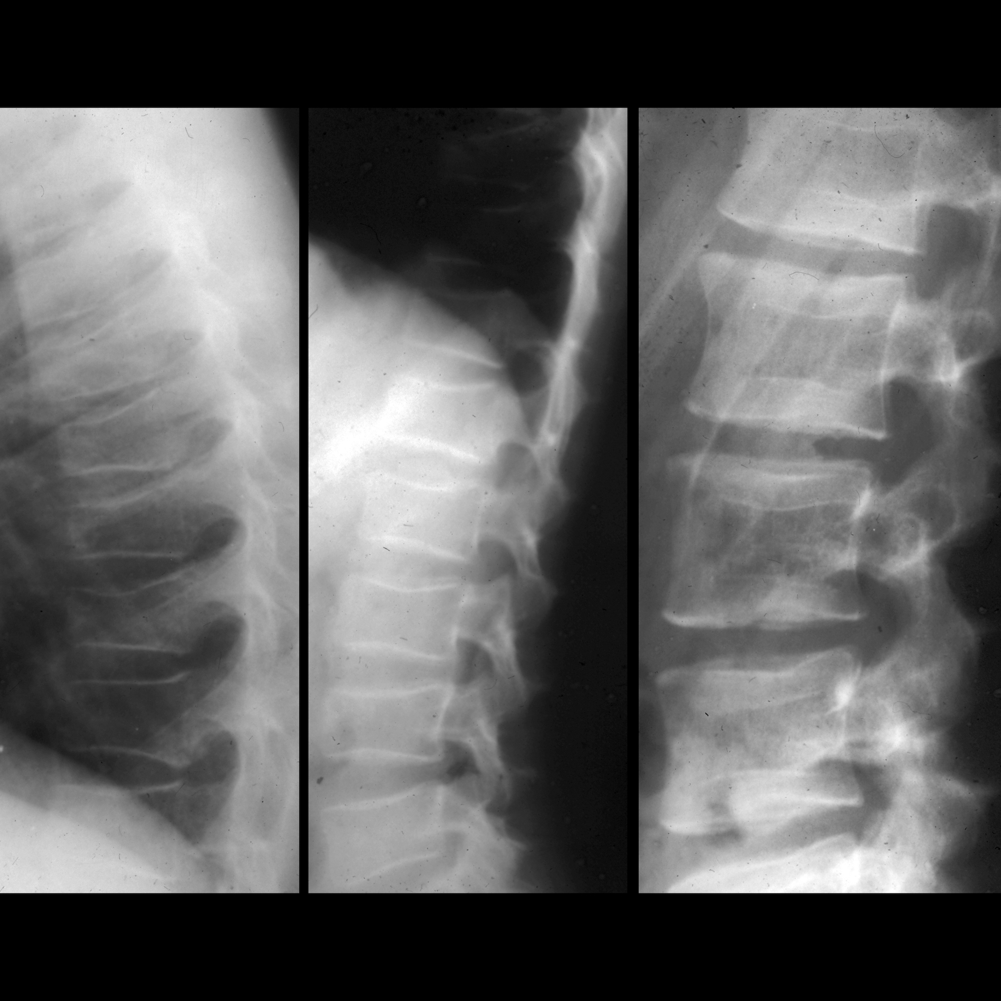 School ager with back pain | Pediatric Radiology Case | Pediatric ...