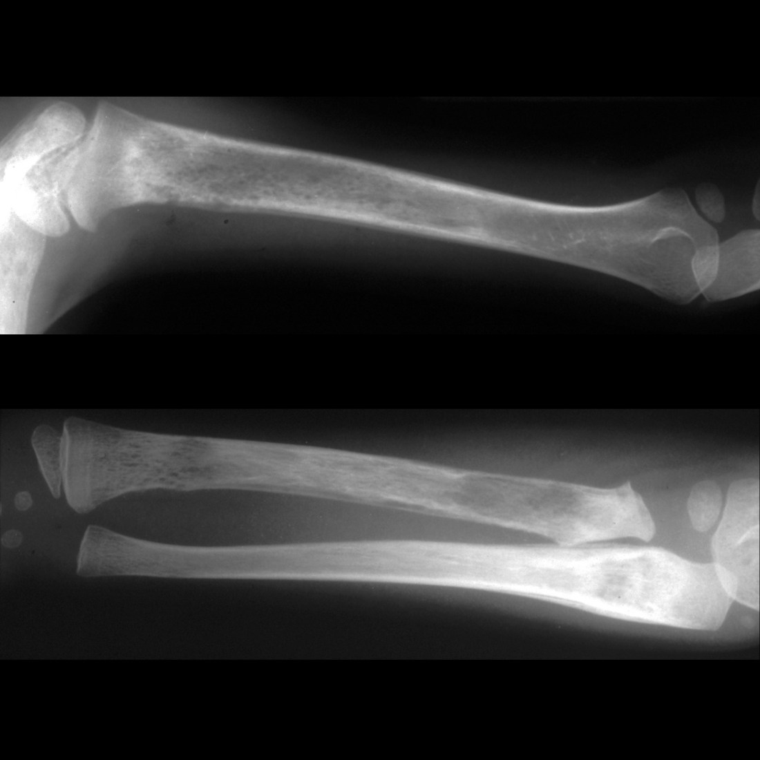 Neuroblastoma | Pediatric Radiology Reference Article | Pediatric ...