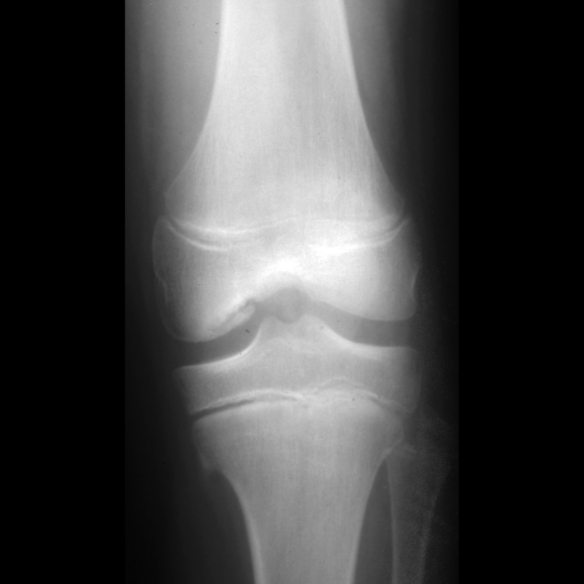 School ager with knee pain | Pediatric Radiology Case | Pediatric ...