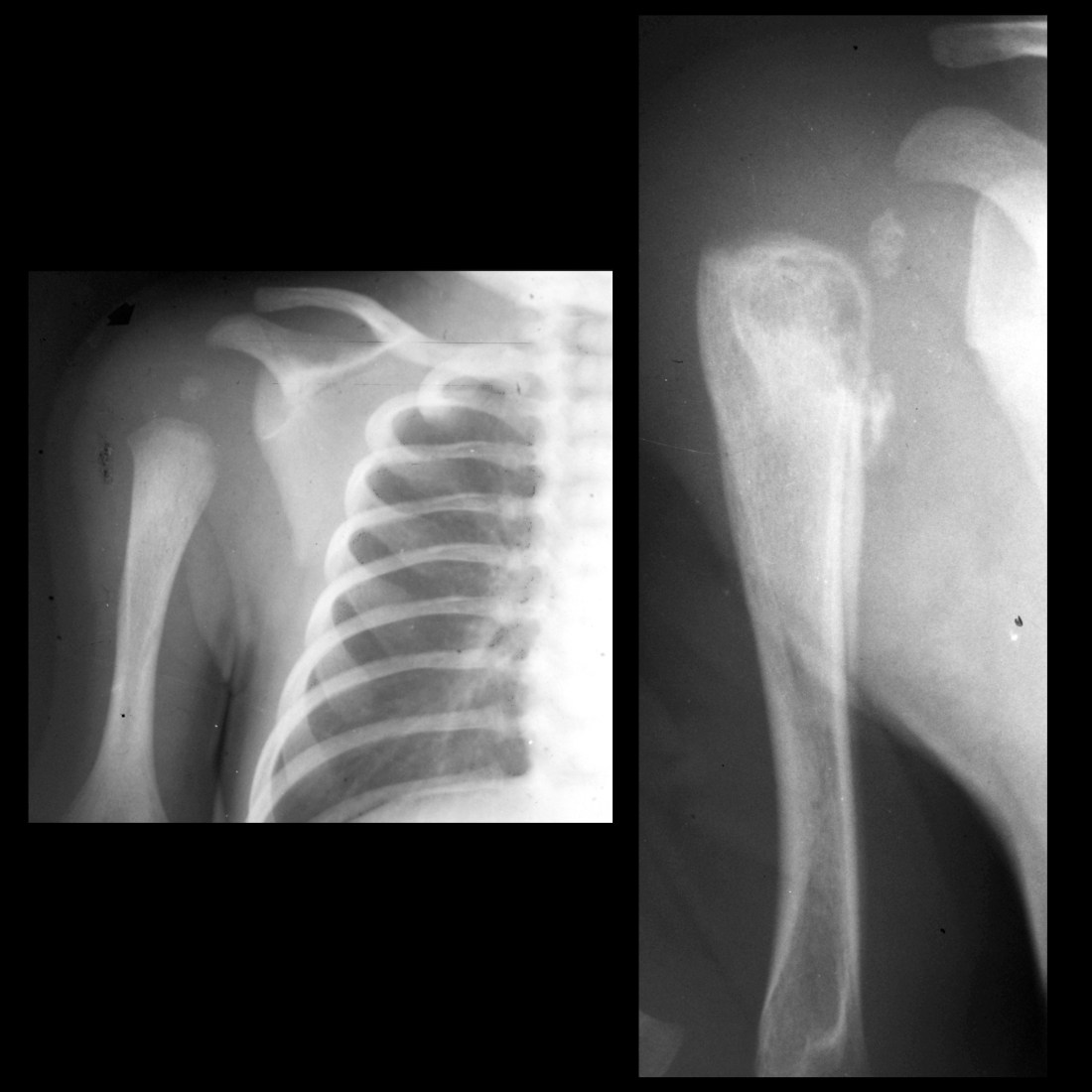 Infant with decreased motion of the right arm | Pediatric Radiology ...