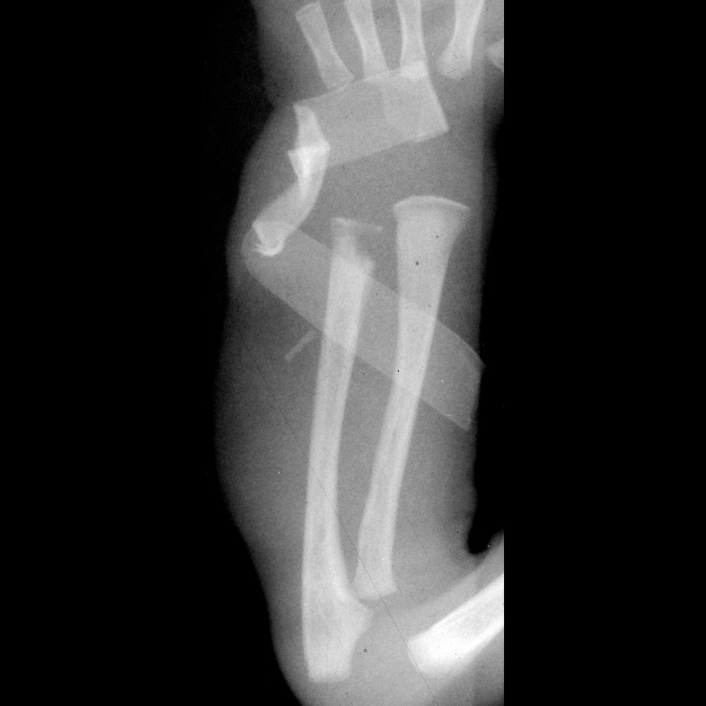 Pediatric Acute Osteomyelitis – Beyond Neonatal To 18 Months ...
