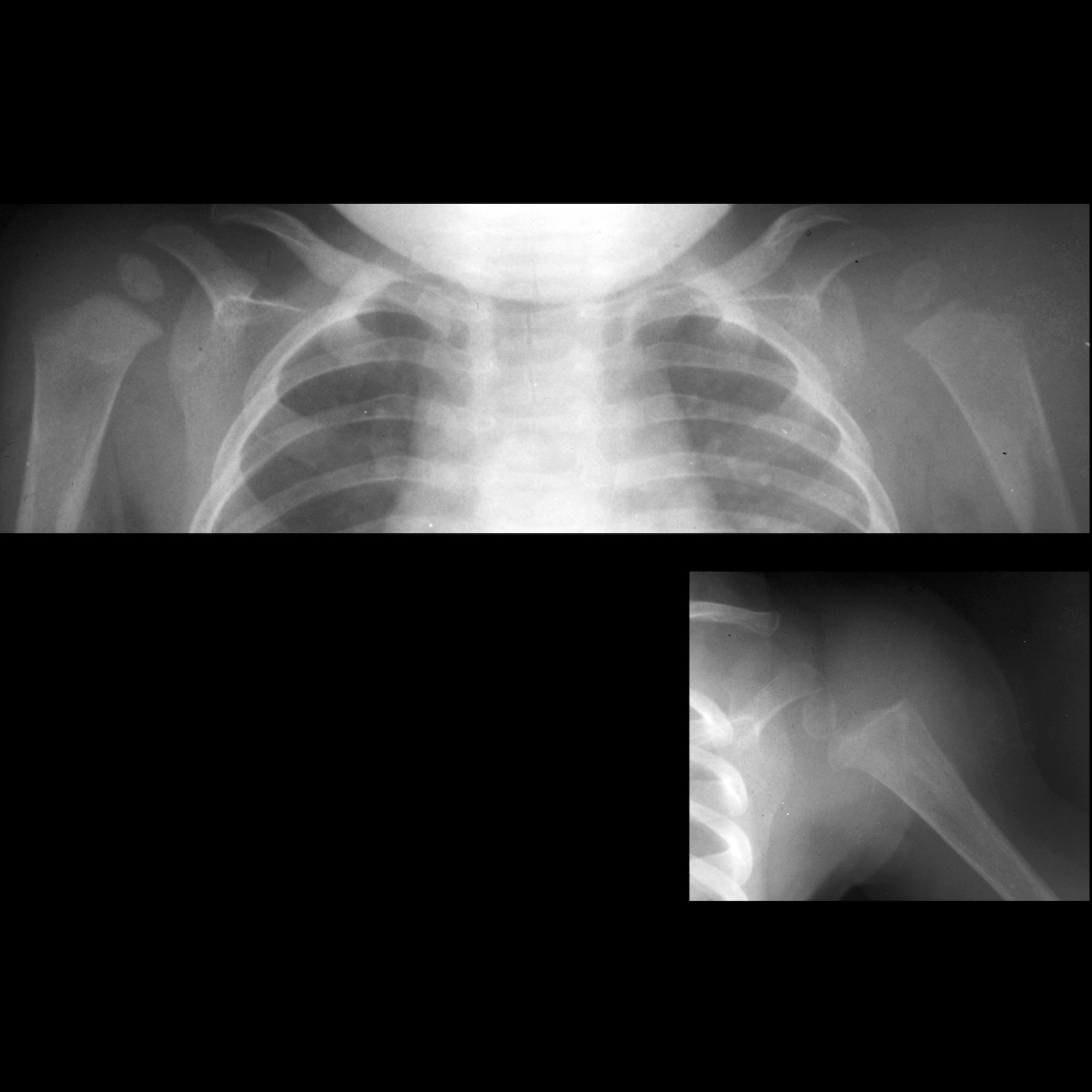 Infant with a warm, red, swollen left shoulder | Pediatric Radiology ...