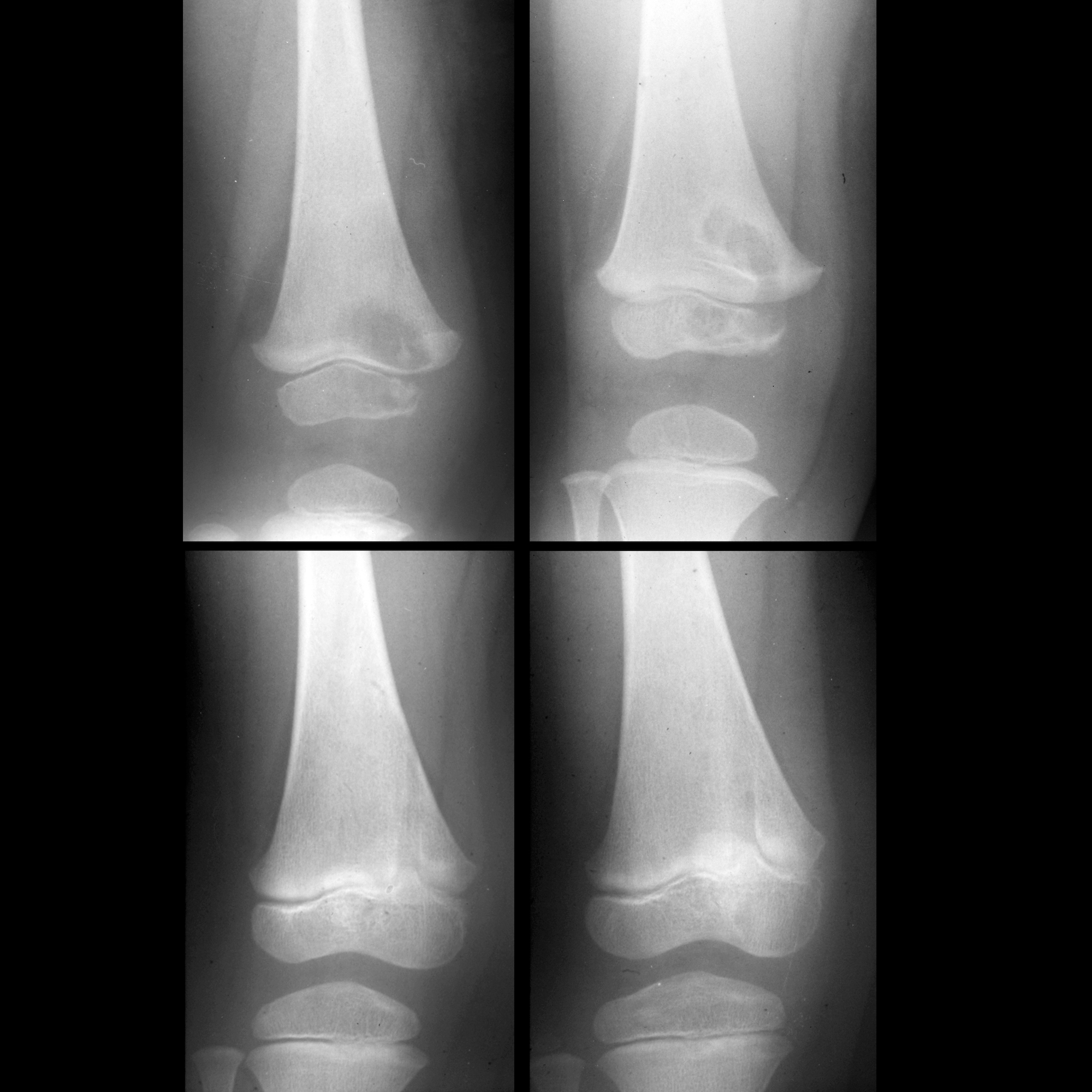 Pediatric Chronic Osteomyelitis | Pediatric Radiology Reference Article ...