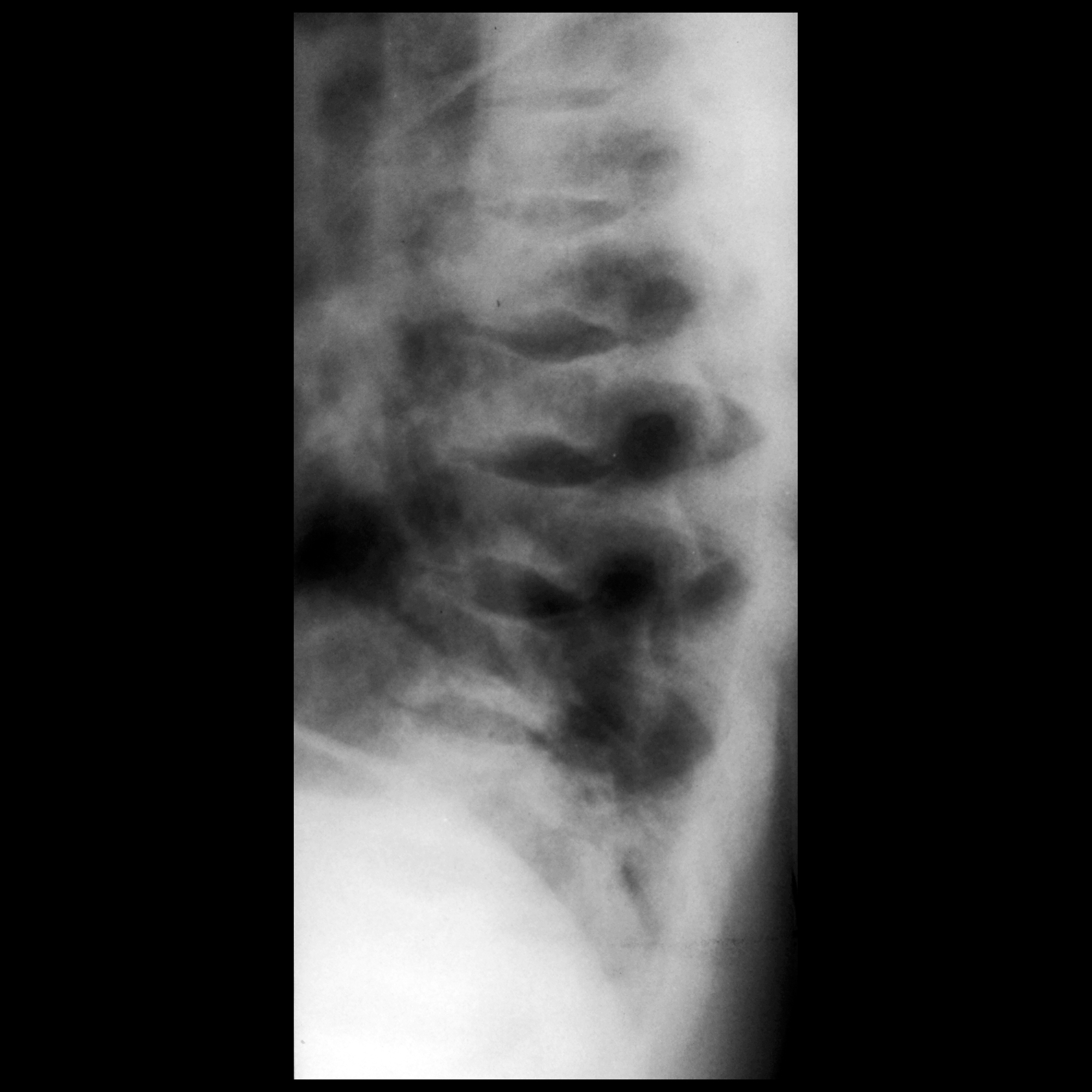 Pediatric Sickle Cell Disease Musculoskeletal | Pediatric Radiology ...