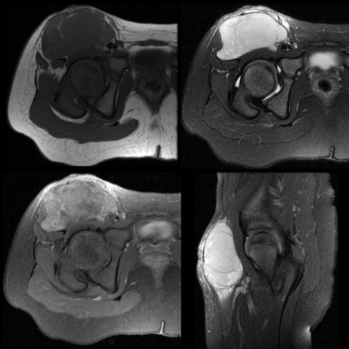 Teenager with right groin mass | Pediatric Radiology Case | Pediatric ...