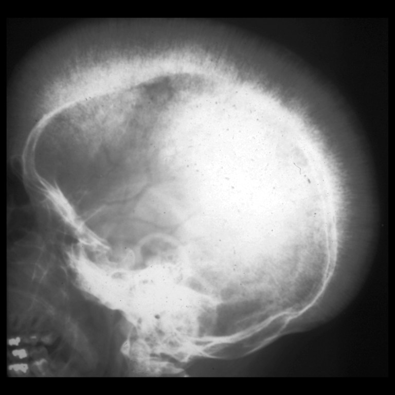 Pediatric Calvarial Thickening | Pediatric Radiology Reference Article ...