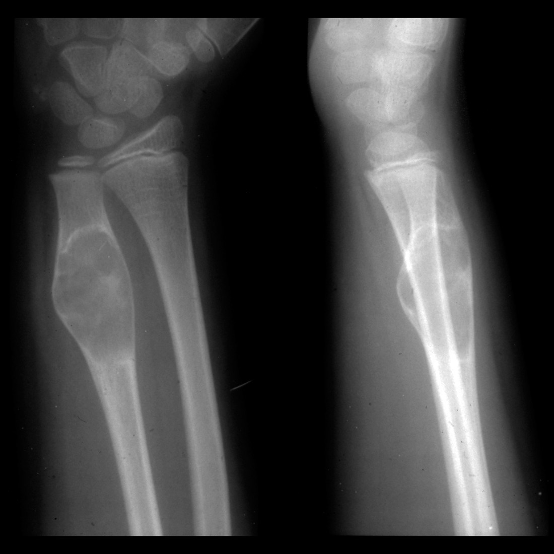 School ager with wrist pain after a fall on an outstretched hand ...