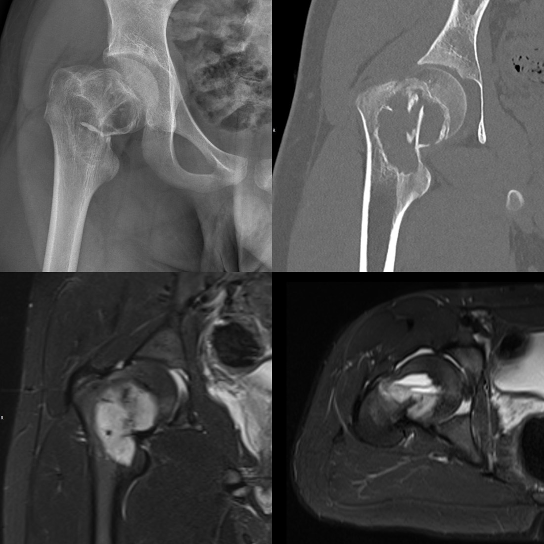 Pediatric Pathologic Fracture | Pediatric Radiology Reference Article ...