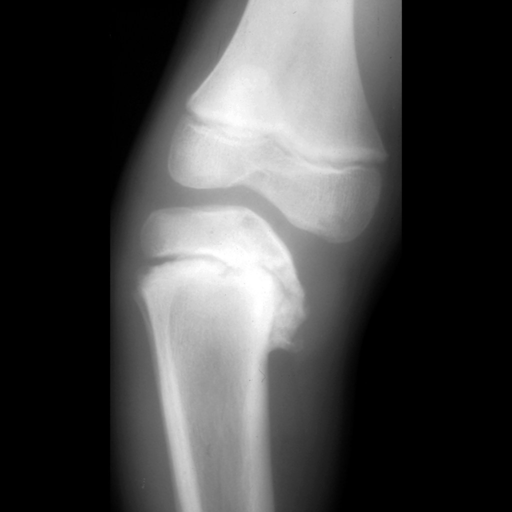 Blount Disease | Pediatric Radiology Reference Article | Pediatric ...