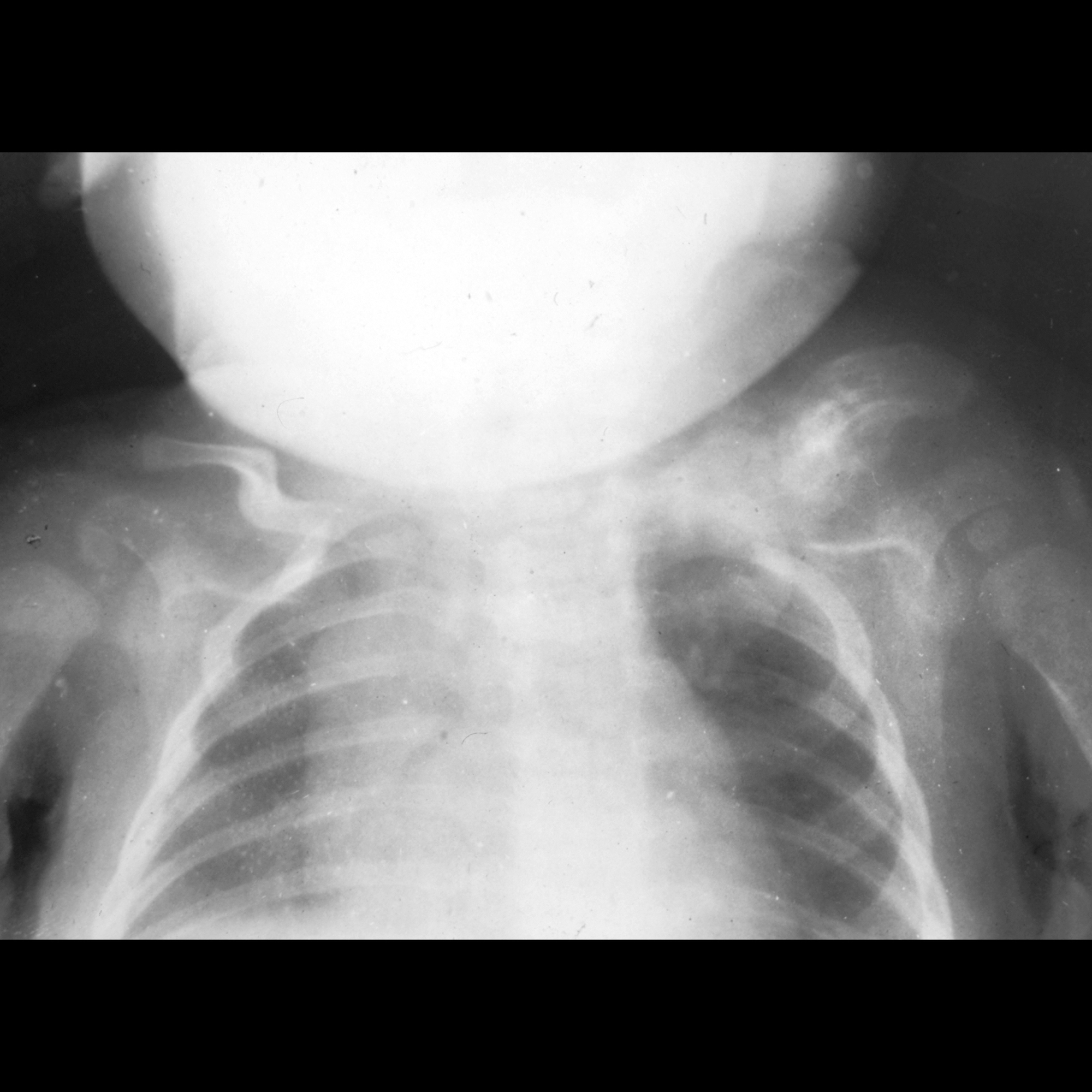 Infantile Cortical Hyperostosis | Pediatric Radiology Reference Article ...