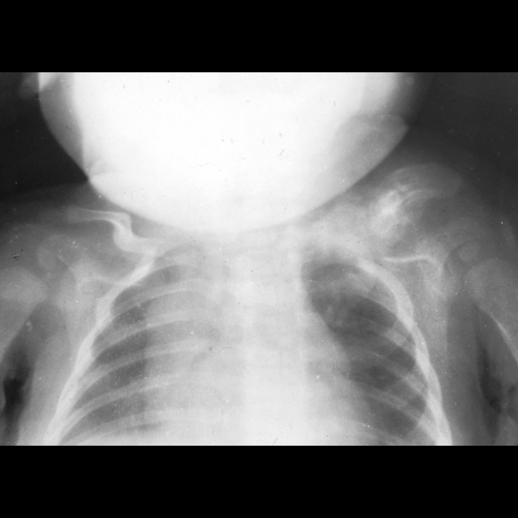 Left Clavicle X Ray