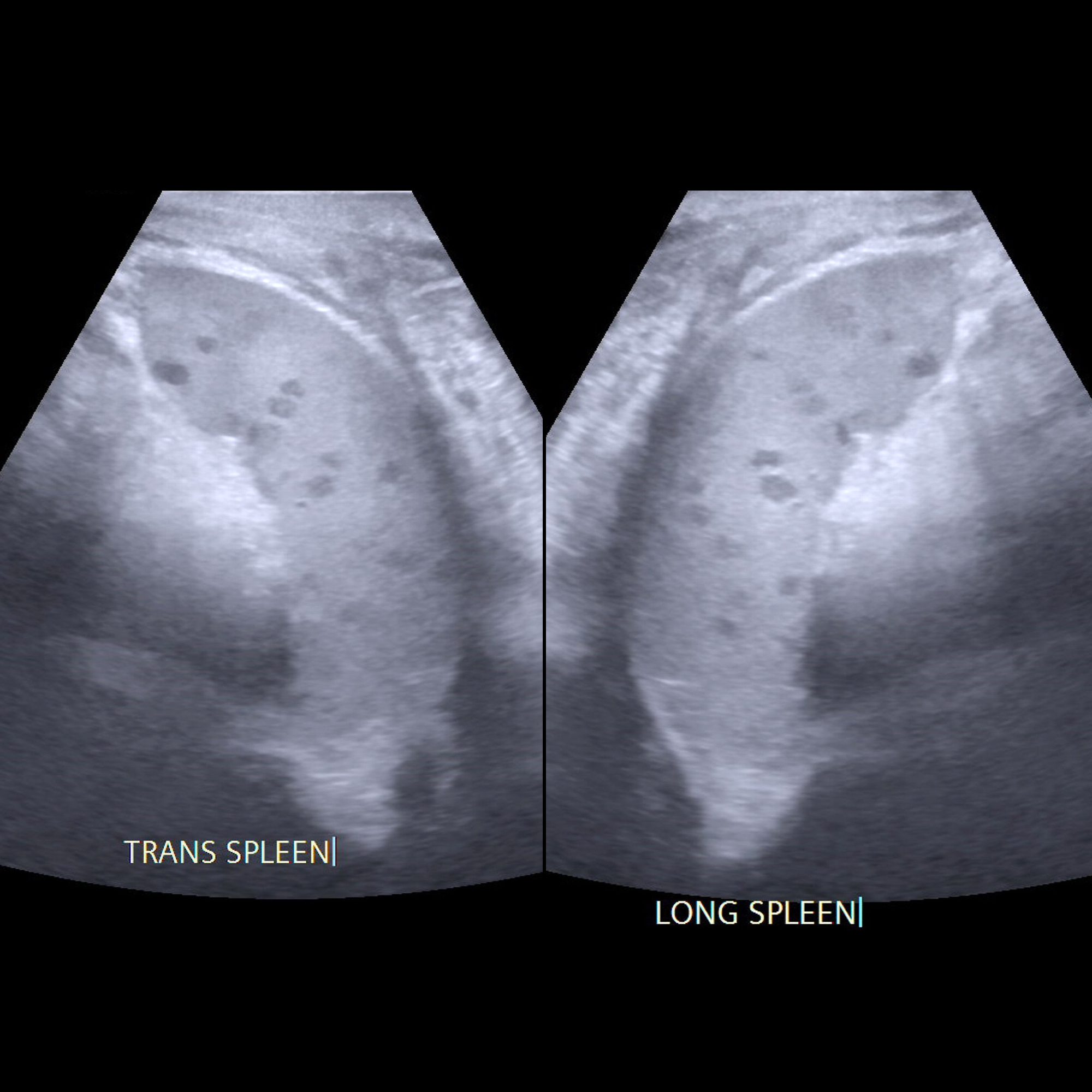 Pediatric Candidial Liver Microabscesses | Pediatric Radiology ...