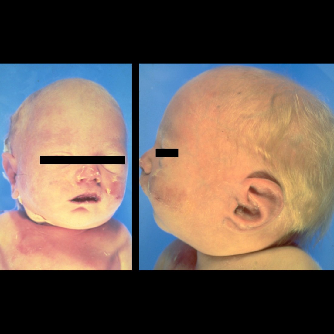 Oligohydramnios | Pediatric Radiology Reference Article | Pediatric ...