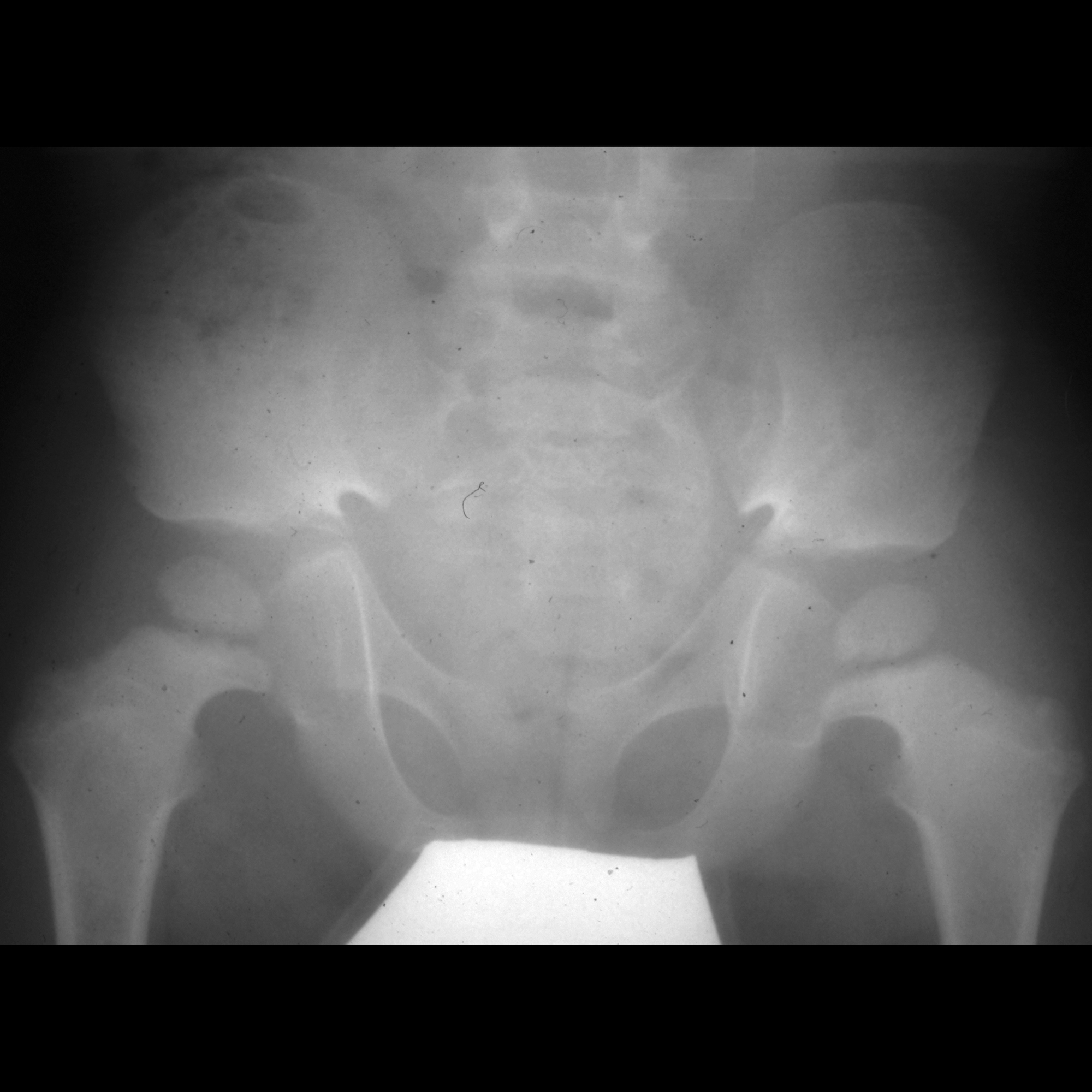 Achondroplasia | Pediatric Radiology Reference Article | Pediatric ...