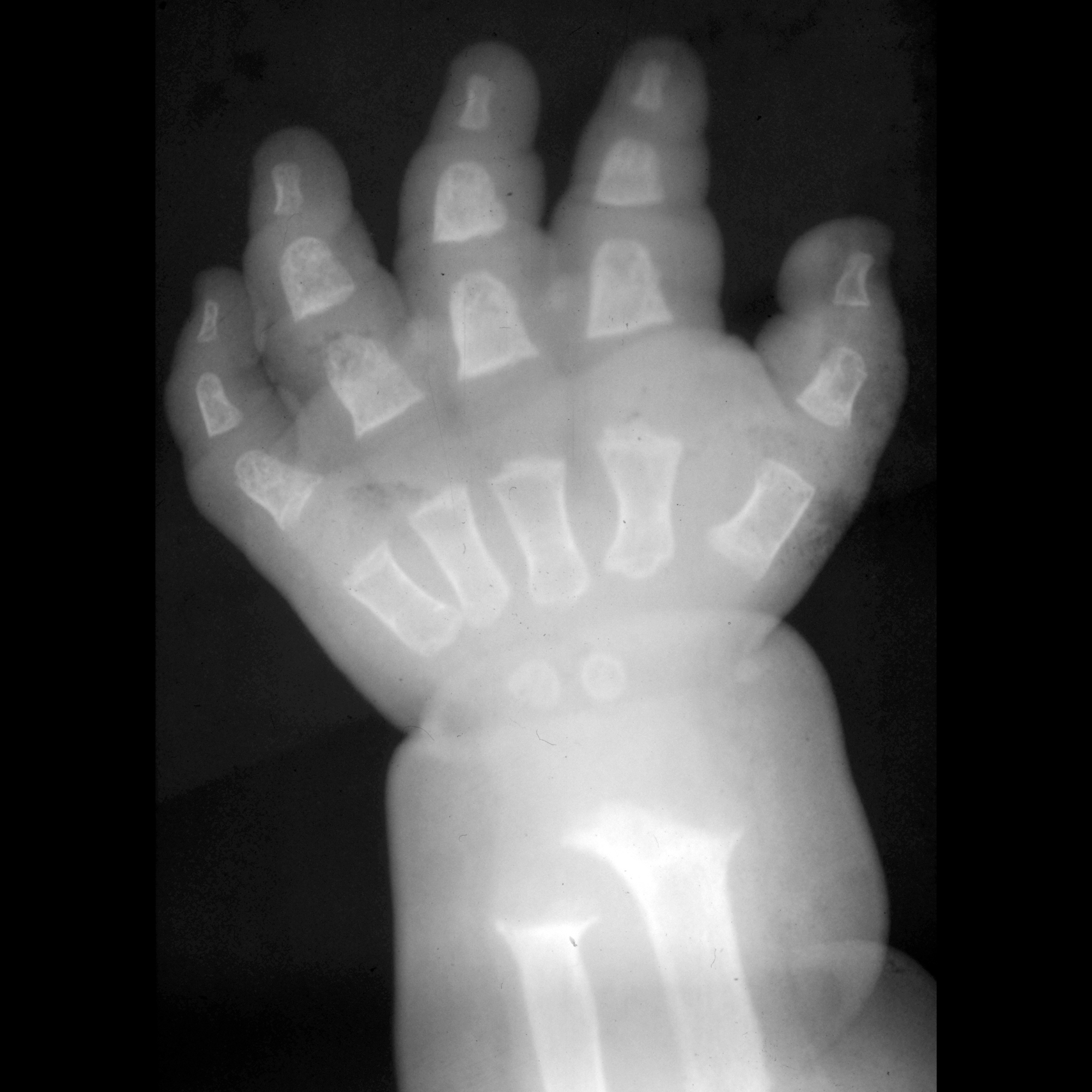 Preschooler with short stature | Pediatric Radiology Case | Pediatric ...