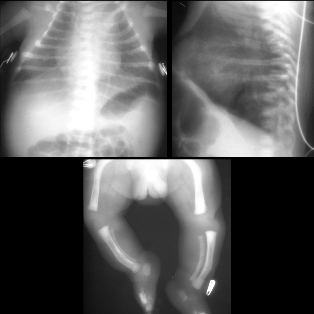 Campomelic Dysplasia | Pediatric Radiology Reference Article ...