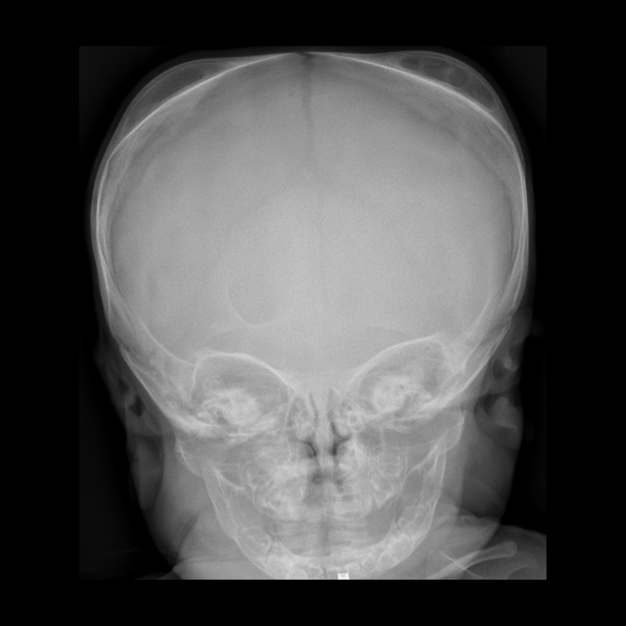 Cephalohematoma | Pediatric Radiology Reference Article | Pediatric ...