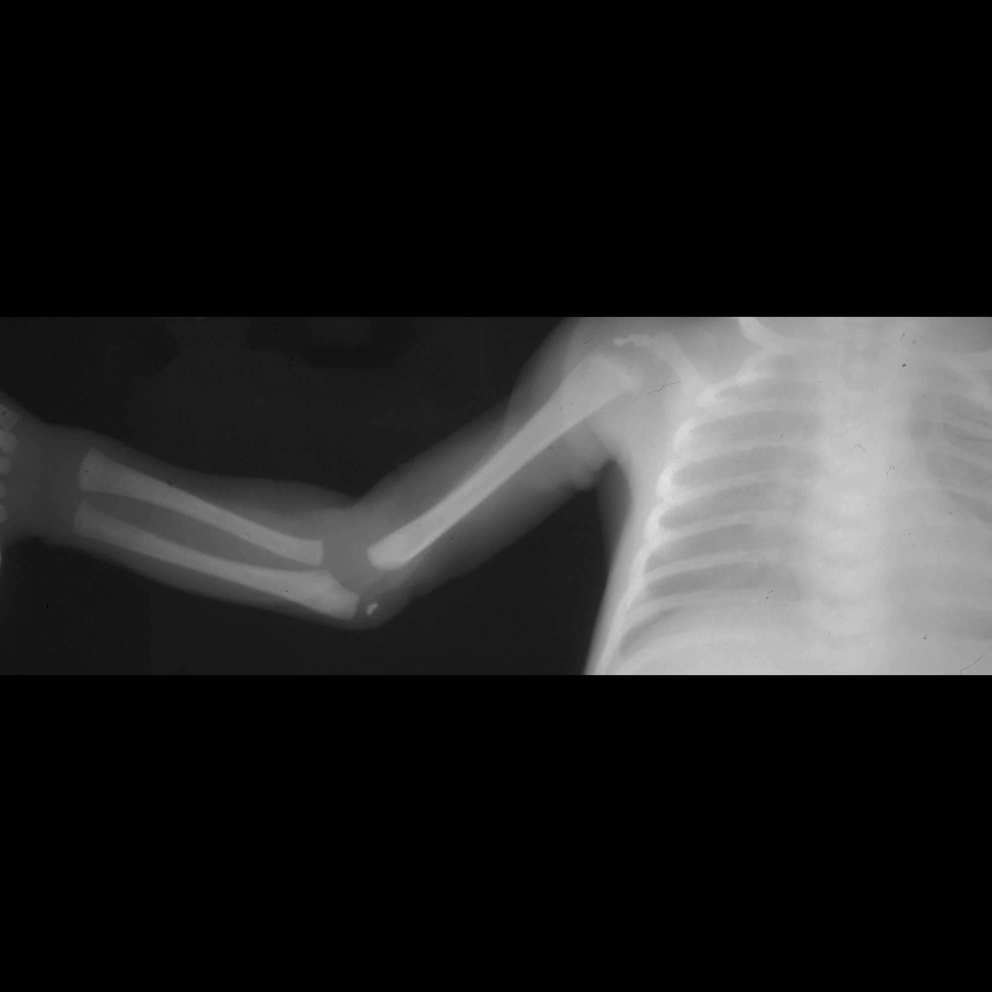 Chondrodysplasia Punctata | Pediatric Radiology Reference Article ...