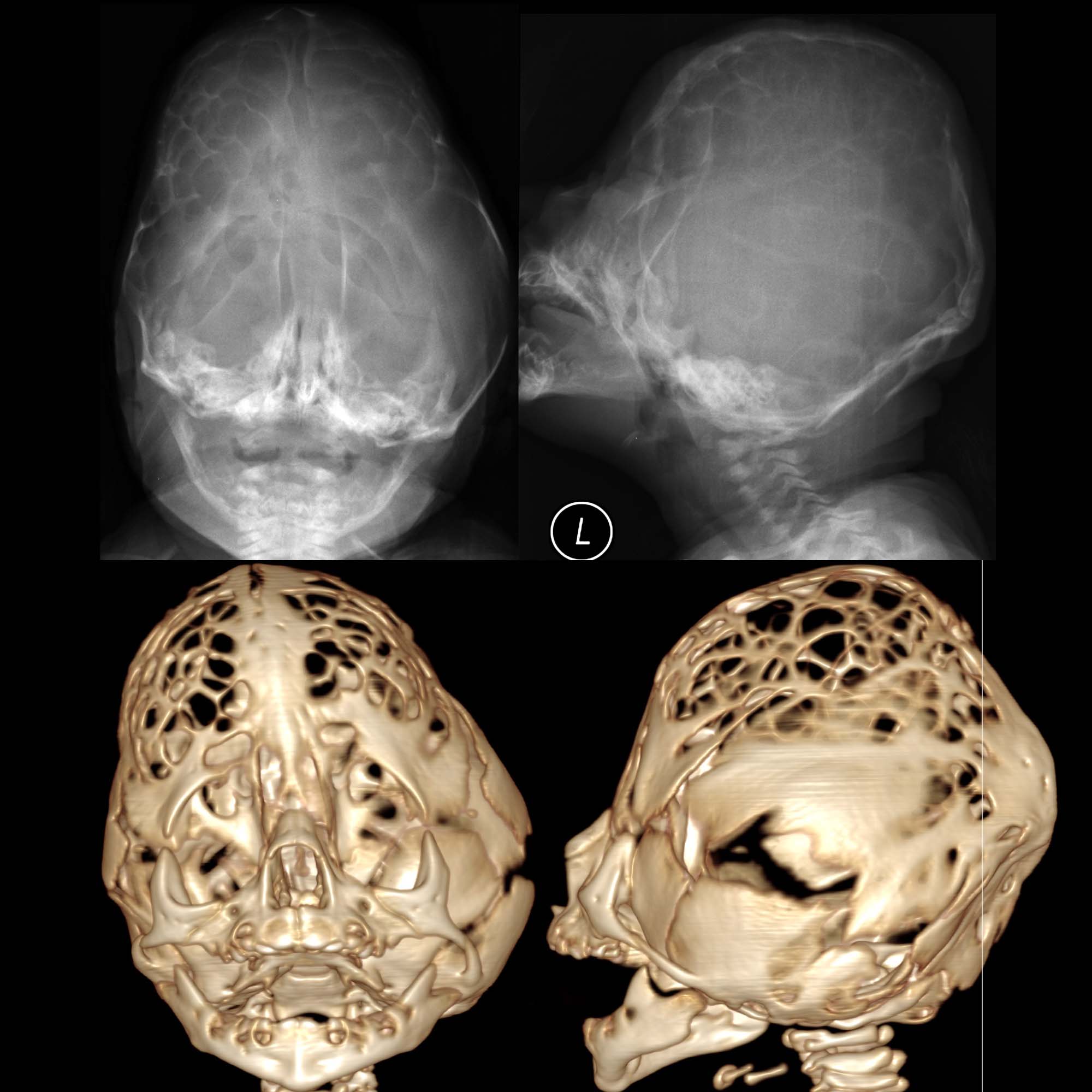 Cloverleaf Skull | Pediatric Radiology Reference Article | Pediatric ...
