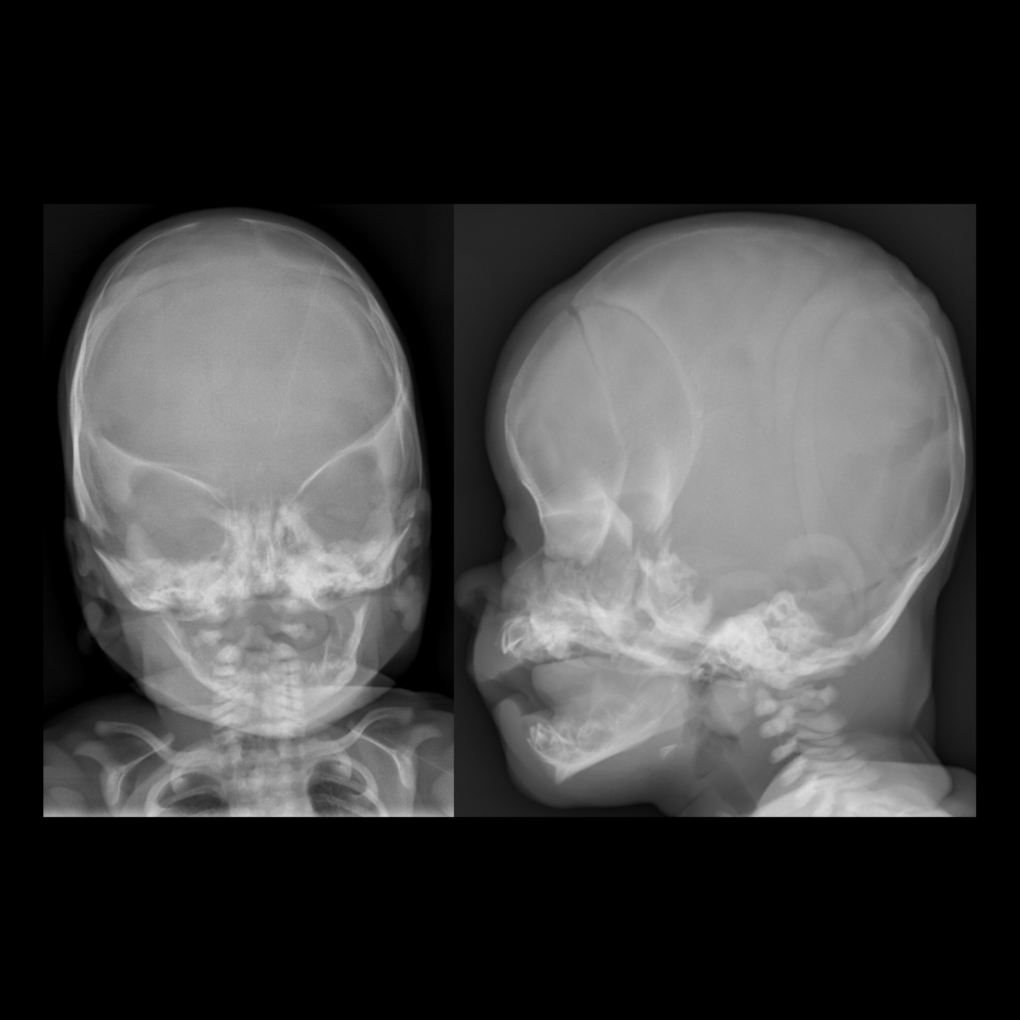 Craniosynostosis | Pediatric Radiology Reference Article | Pediatric ...