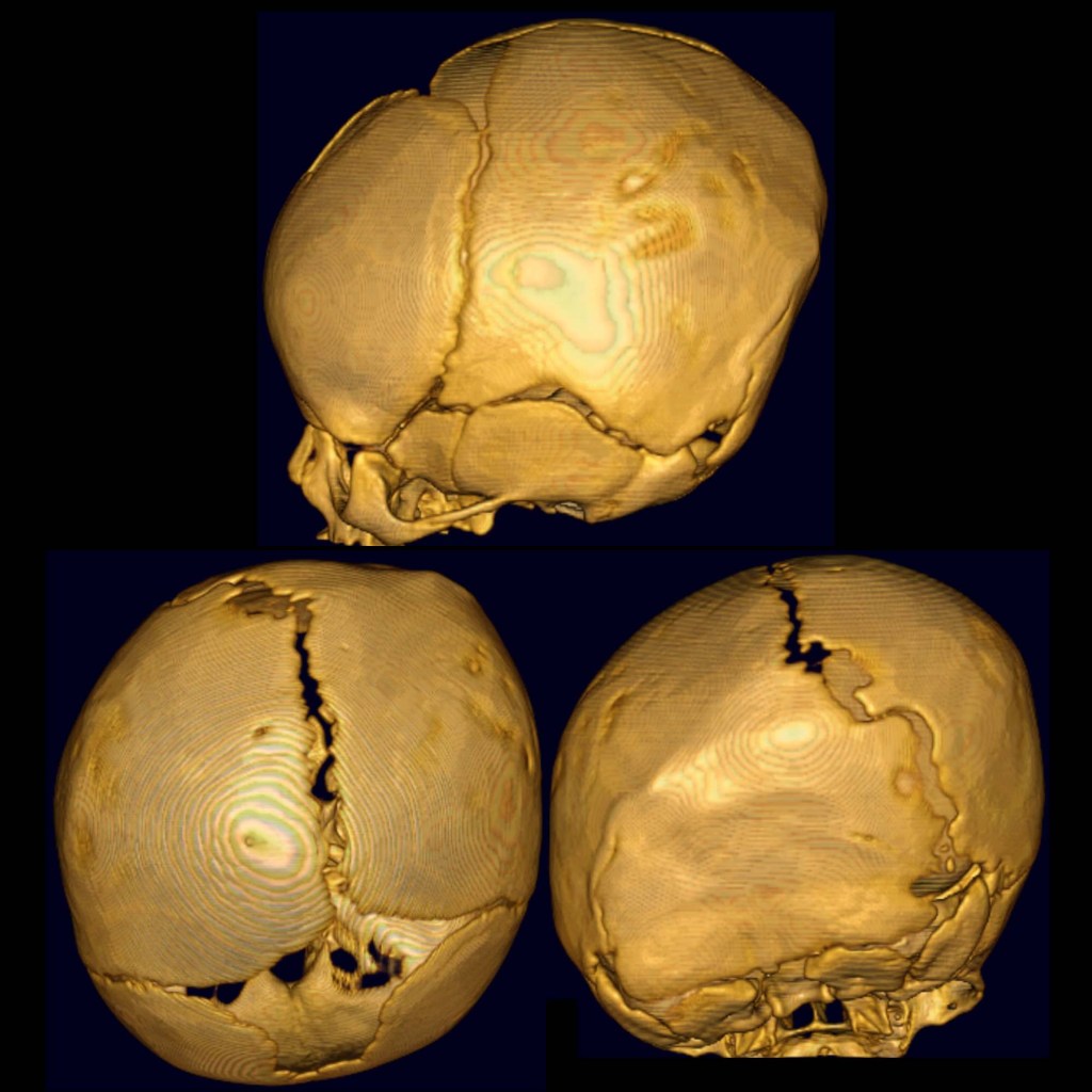 Craniosynostosis | Pediatric Radiology Reference Article | Pediatric ...