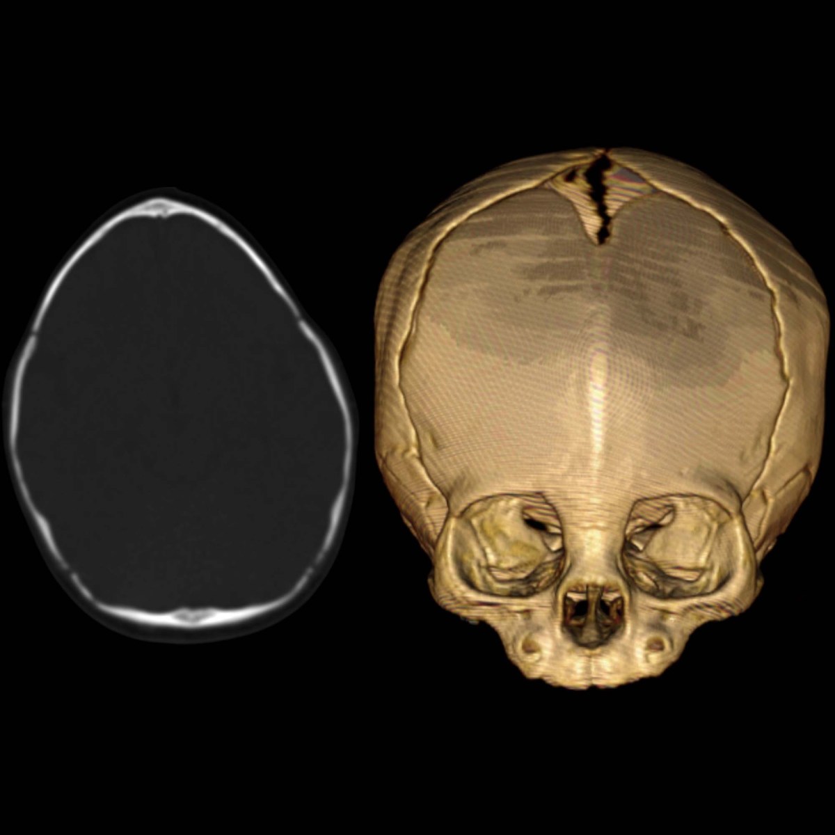 Infant with a bump on the forehead | Pediatric Radiology Case ...