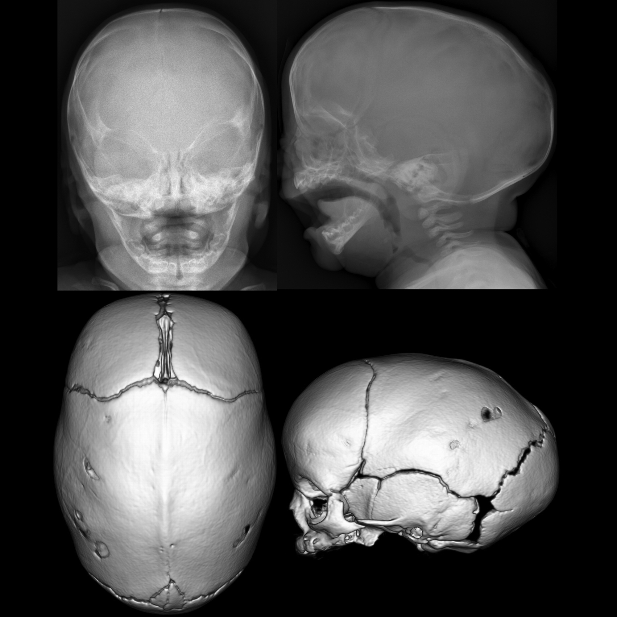 Craniosynostosis | Pediatric Radiology Reference Article | Pediatric ...