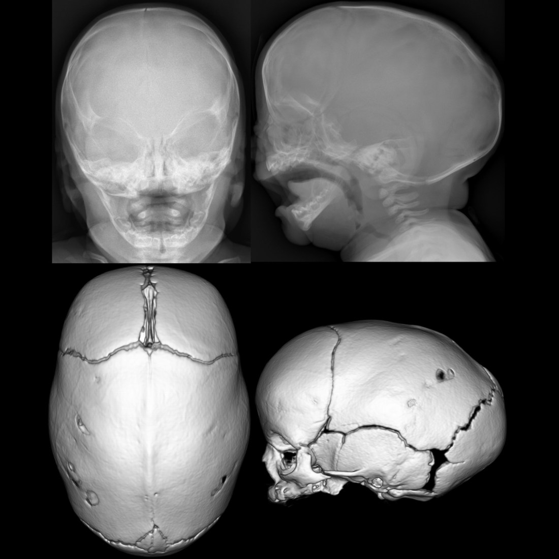 Infant with a palpable ridge on the top of the head | Pediatric ...
