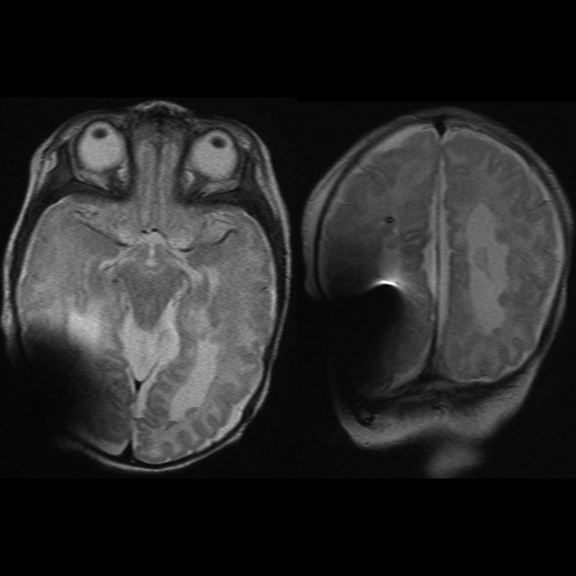 Heterotopia | Pediatric Radiology Reference Article | Pediatric Imaging ...