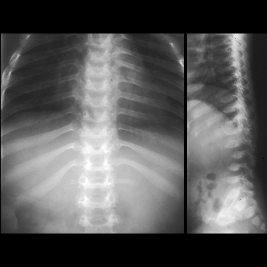 Morquio Syndrome