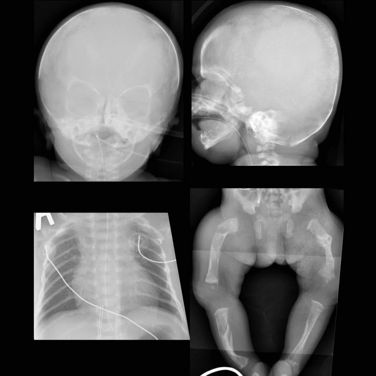 Newborn with abnormally shaped extremities | Pediatric Radiology Case ...