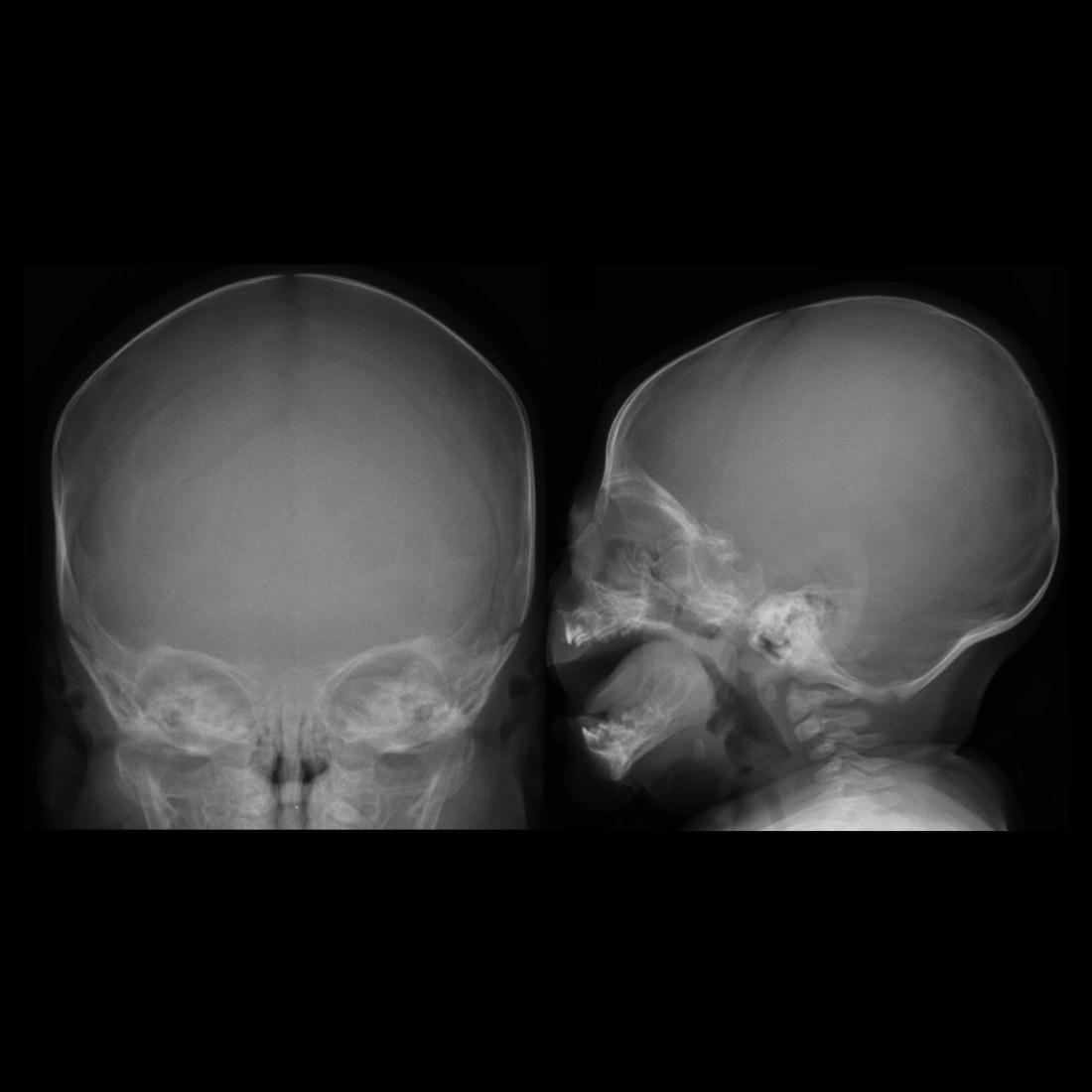 Positional Plagiocephaly | Pediatric Radiology Reference Article ...