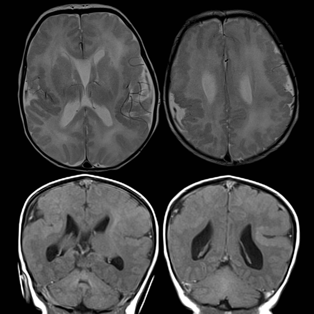 Polymicrogyria | Pediatric Radiology Reference Article | Pediatric ...