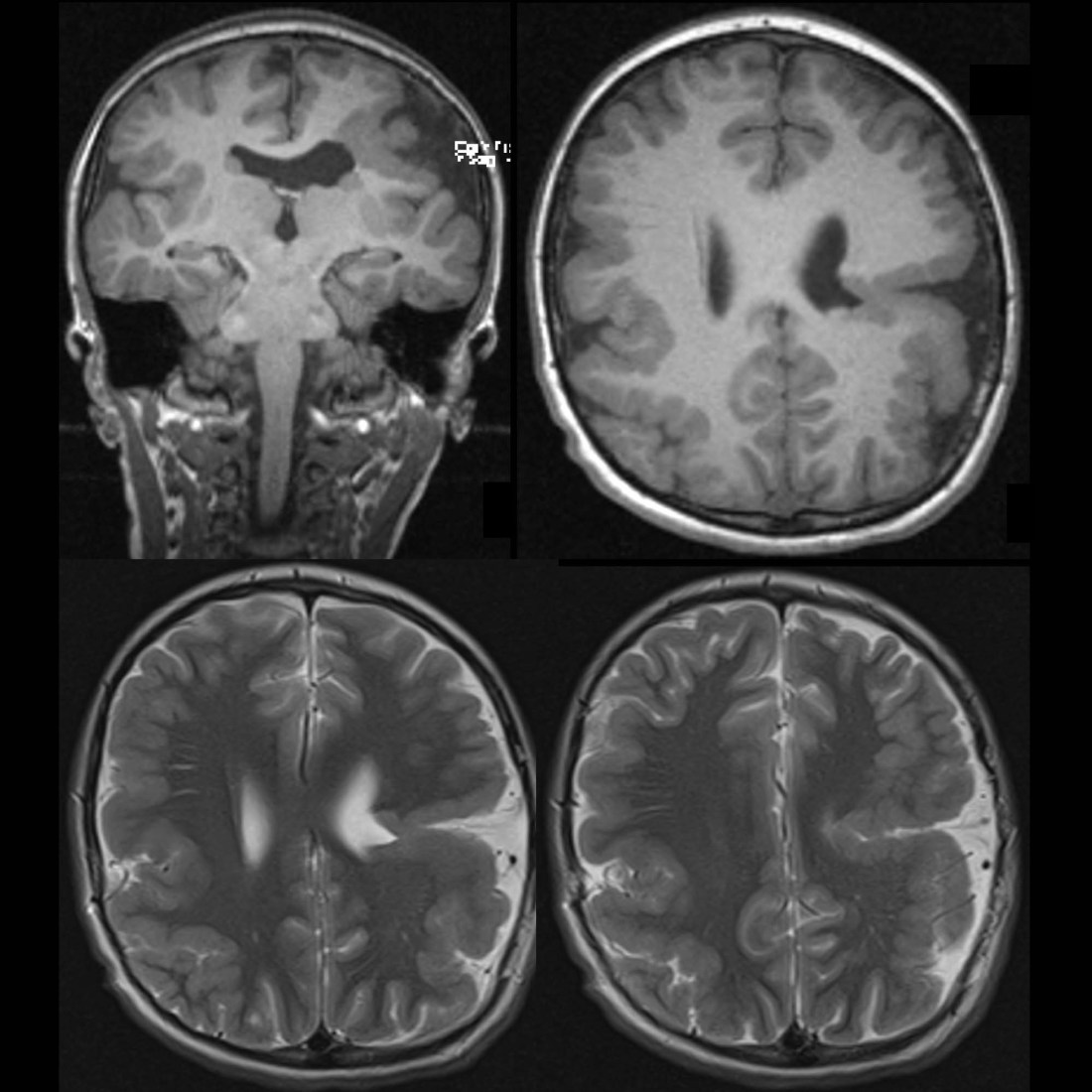 Polymicrogyria | Pediatric Radiology Reference Article | Pediatric ...