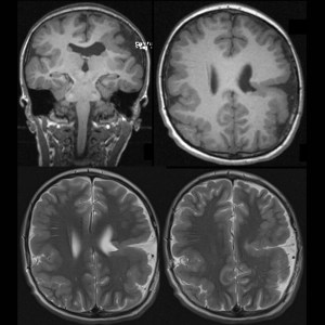 Polymicrogyria | Pediatric Radiology Reference Article | Pediatric ...