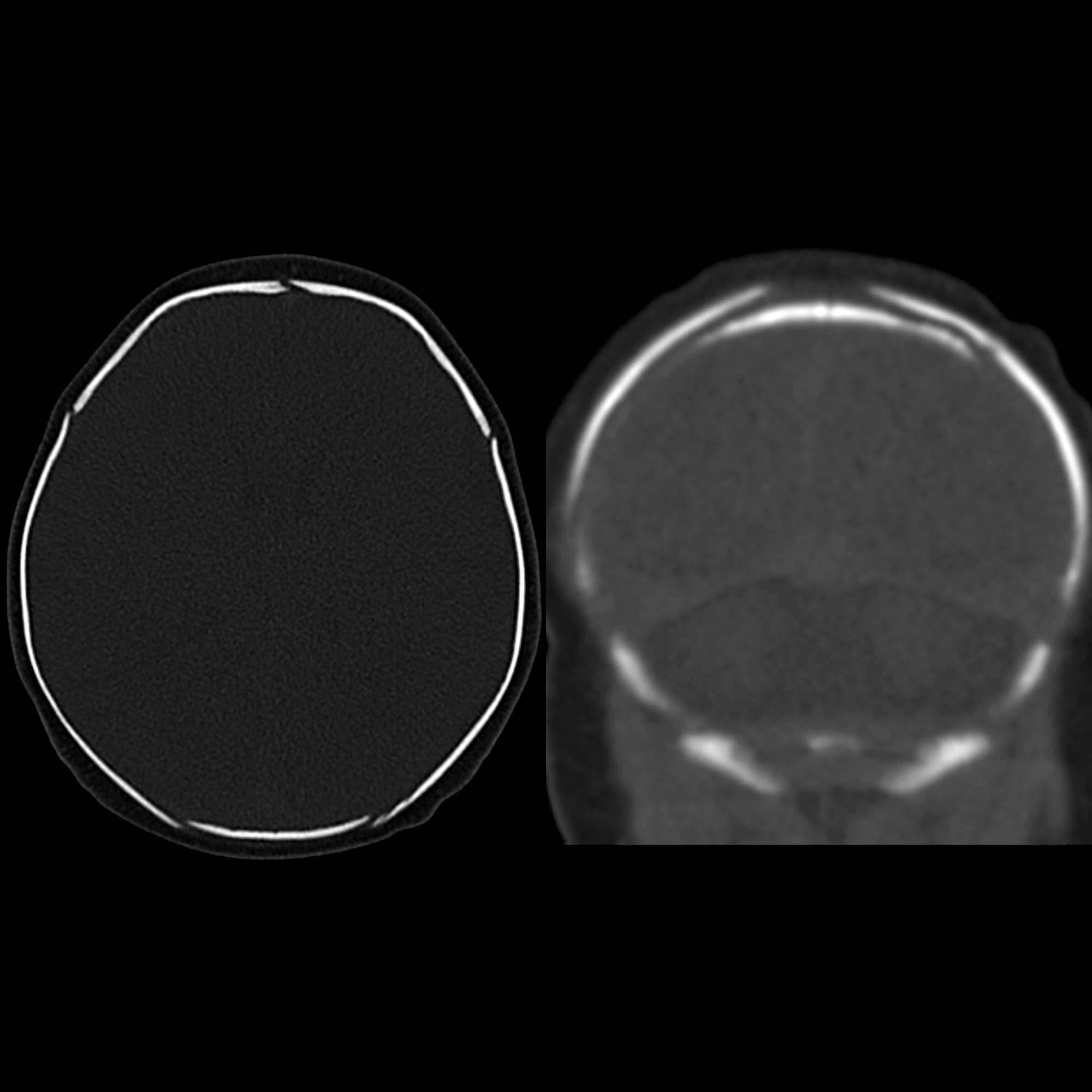 Skull Molding | Pediatric Radiology Reference Article | Pediatric ...