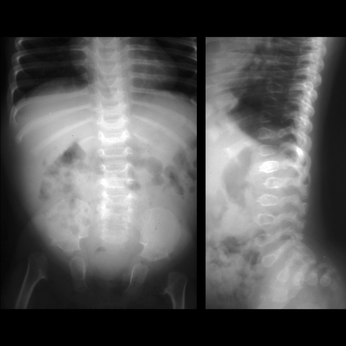 Preschooler with short stature | Pediatric Radiology Case | Pediatric ...