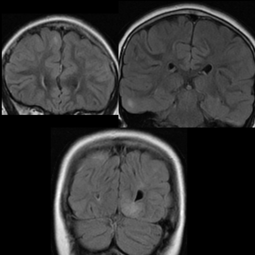 Tuberous Sclerosis | Pediatric Radiology Reference Article | Pediatric ...