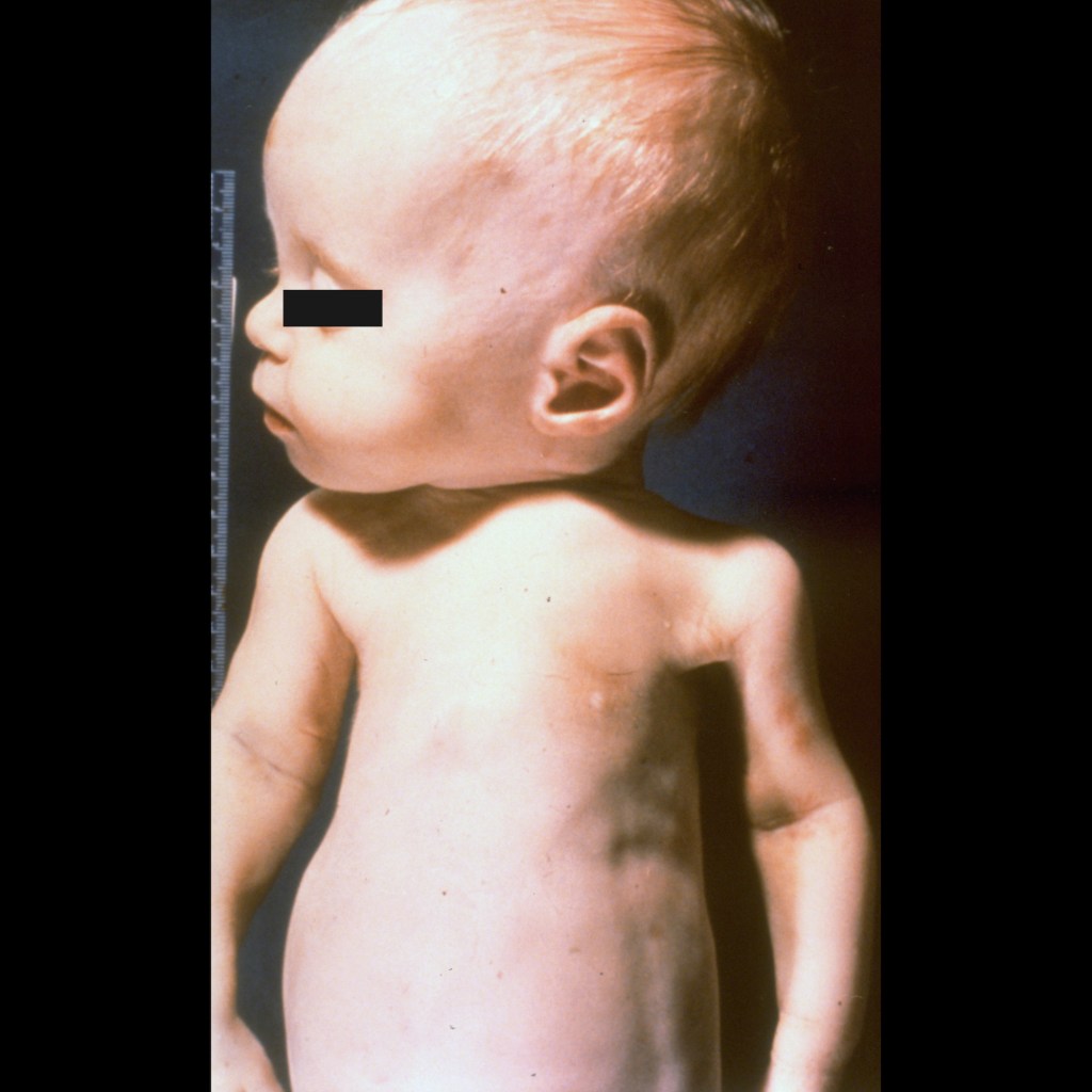 Asphyxiating Thoracic Dystrophy | Pediatric Radiology Reference Article ...