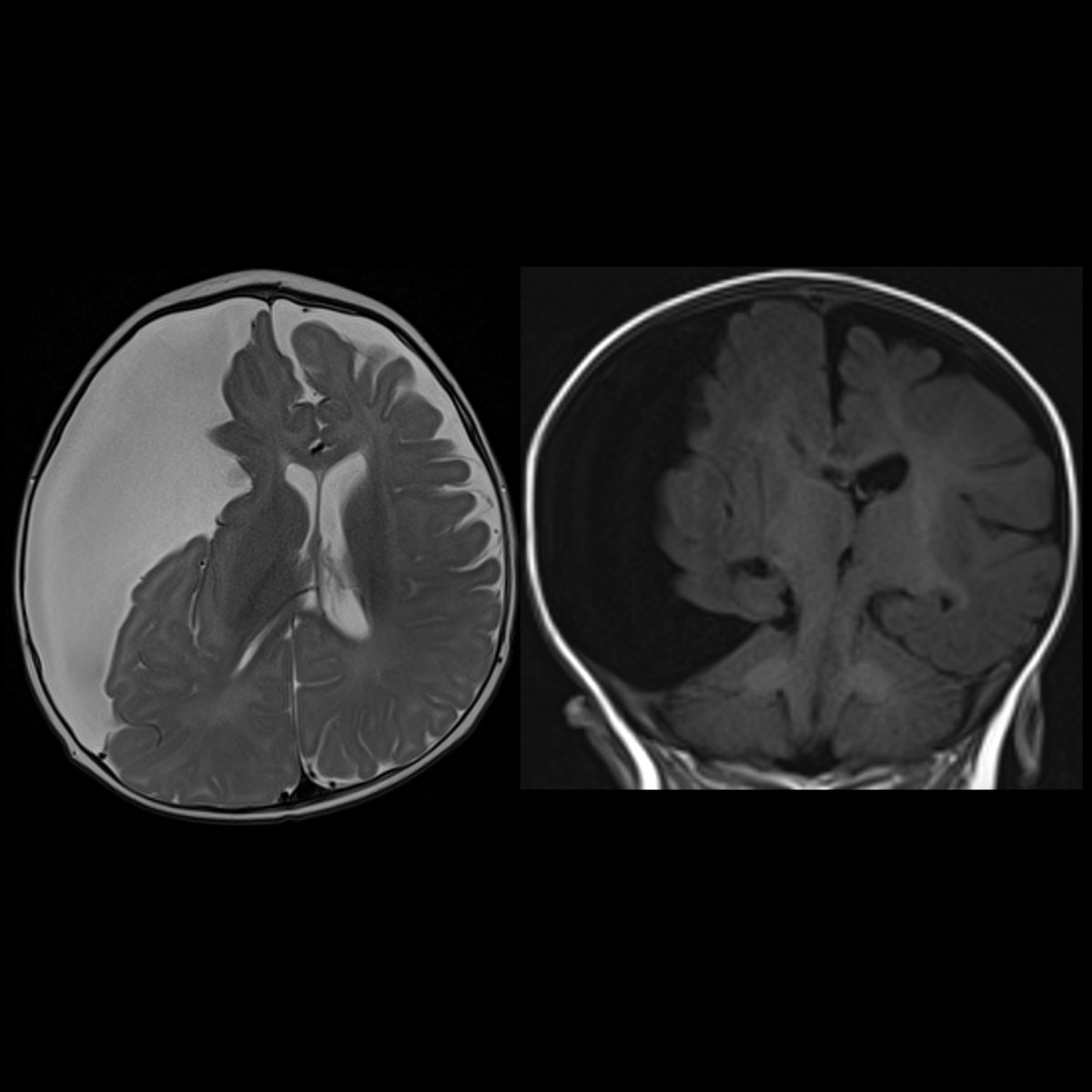 Infant with macrocephaly | Pediatric Radiology Case | Pediatric Imaging ...