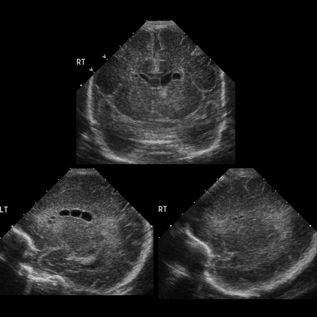 Connatal Cyst | Pediatric Radiology Reference Article | Pediatric ...