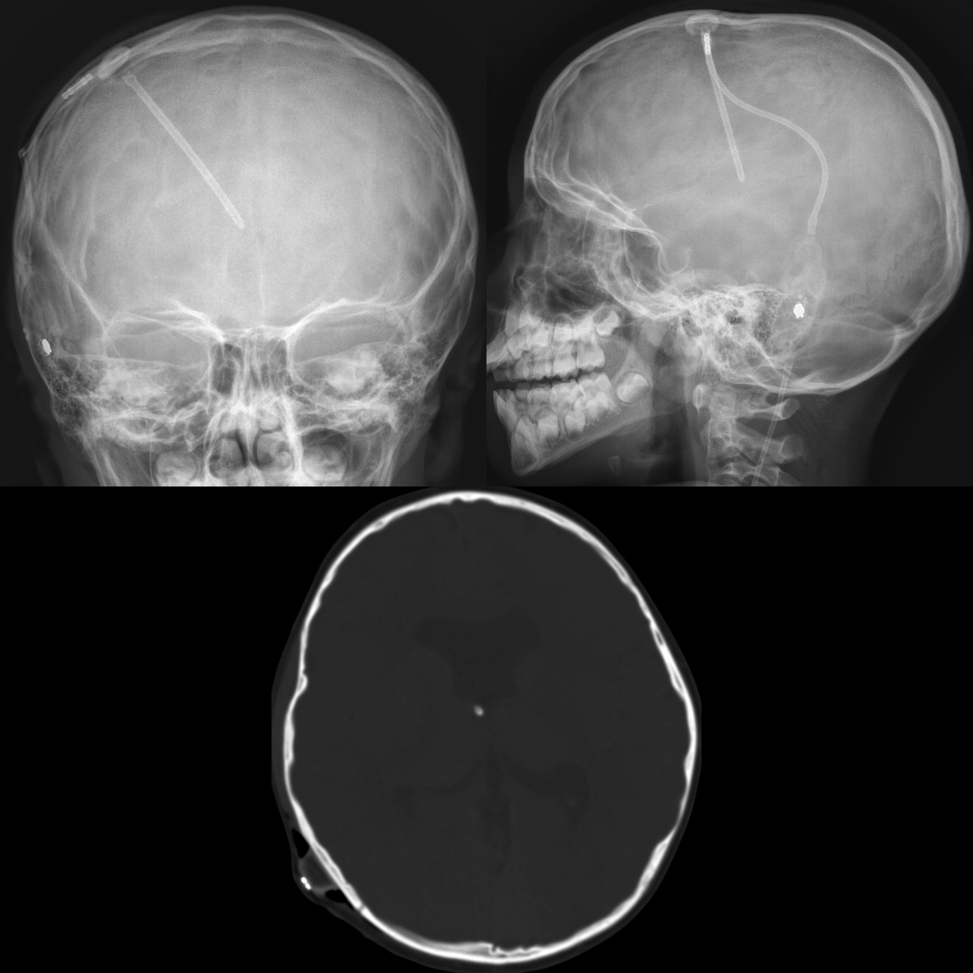 Copper Beaten Skull | Pediatric Radiology Reference Article | Pediatric ...