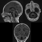 Dandy Walker Variant | Pediatric Radiology Reference Article ...